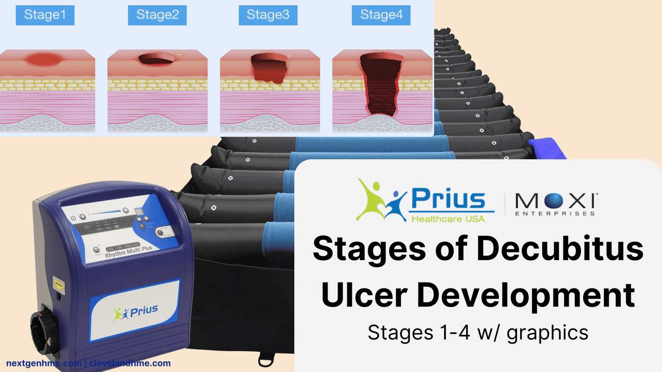 The Stages of Decubitus Ulcer (Bed Sore) Development: A Guide for Clev